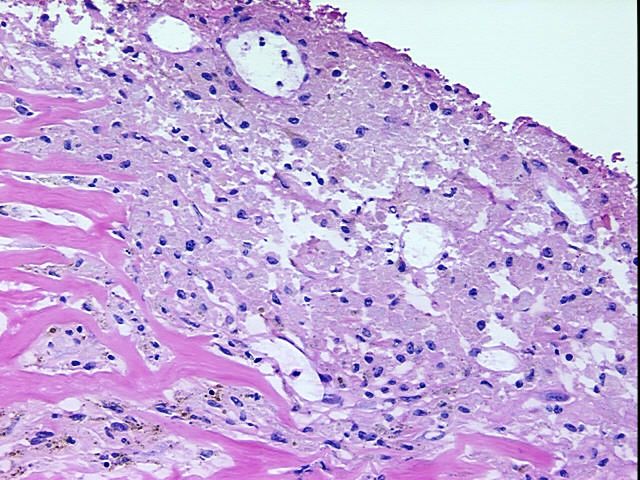 Frozen Tissue Blocks, Endometriotic tissue – CB502542 | OriGene