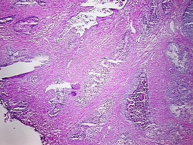 Frozen Tissue Blocks, Prostate | CB522837 | OriGene Technologies Inc.