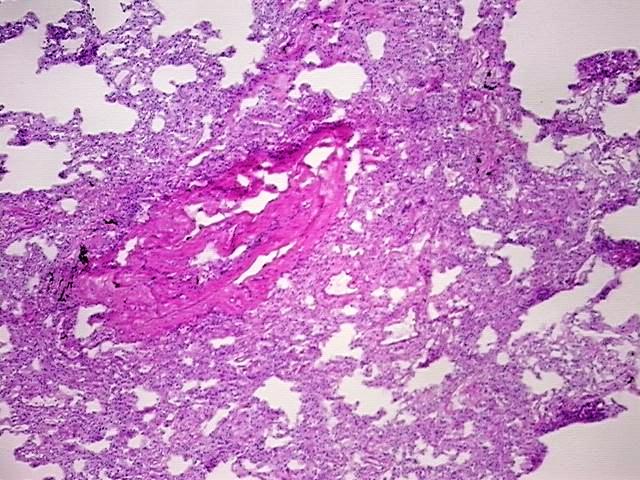 Frozen Tissue Blocks, Lung | CB525309 | OriGene Technologies Inc.