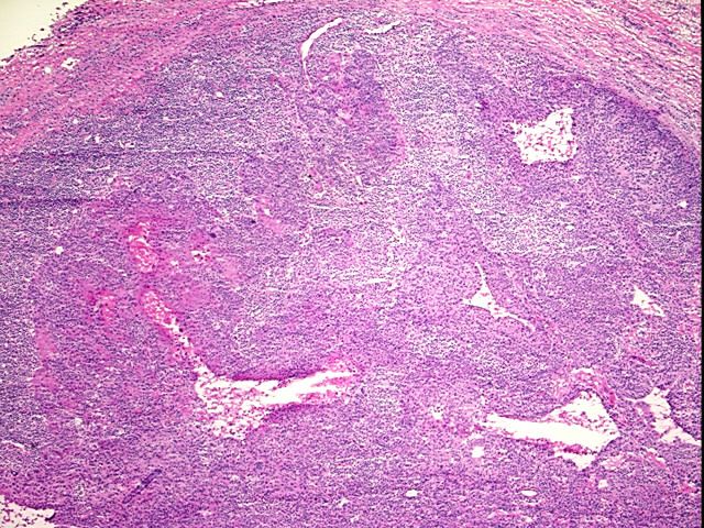 Frozen Tissue Blocks, Metastasis, unknown source | OriGene Technologies ...
