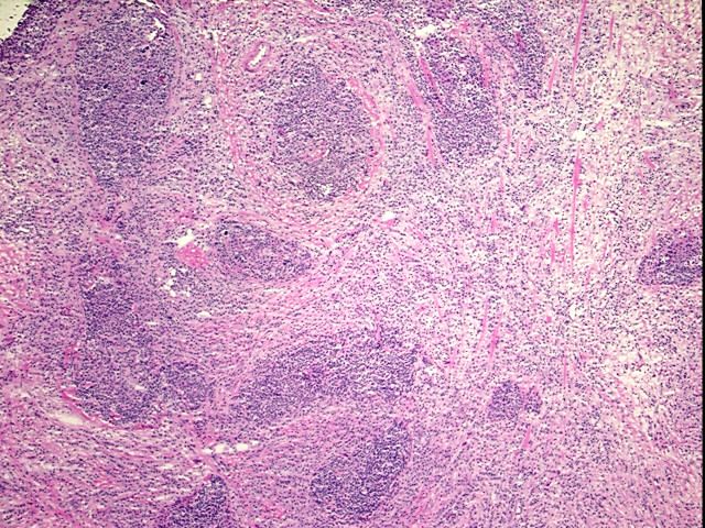 Frozen Tissue Blocks, Metastasis, unknown source | CB616961 | OriGene ...