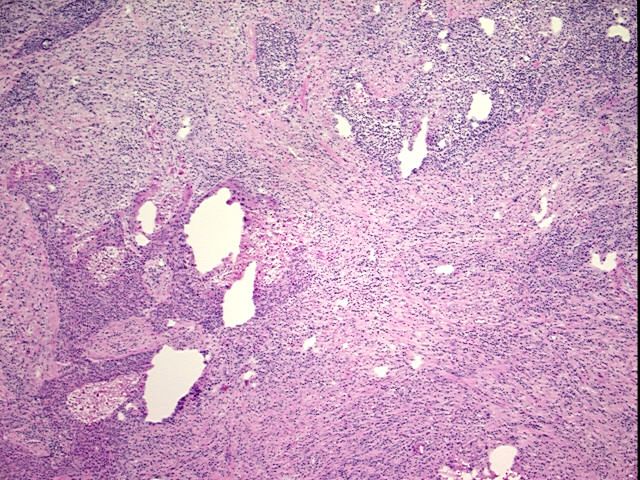 Frozen Tissue Blocks, Metastasis, unknown source | CB616962 | OriGene ...