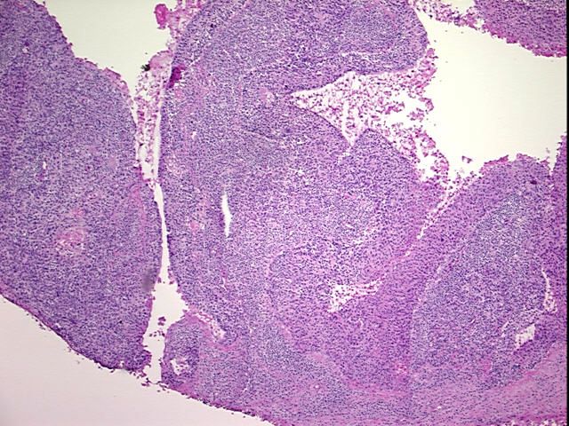 Frozen Tissue Blocks, Metastasis, unknown source | CB616963 | OriGene ...