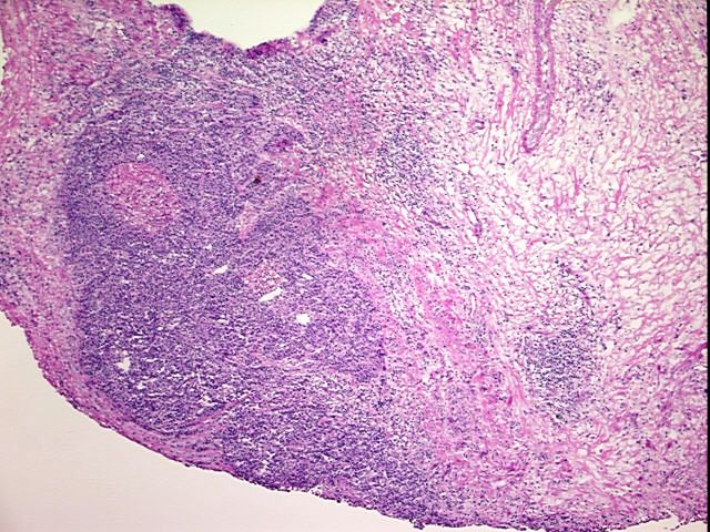 Frozen Tissue Blocks, Metastasis, unknown source | CB616965 | OriGene ...