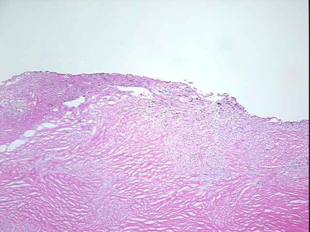 Frozen Tissue Sections, Endometriotic tissue | OriGene Technologies Inc.