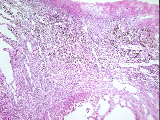 Frozen Tissue Sections, Endometriotic tissue | OriGene Technologies Inc.