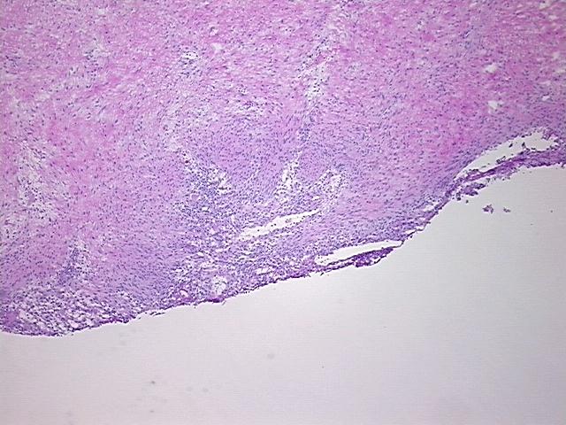 Frozen Tissue Sections, Endometriotic tissue | CS626004 | OriGene ...
