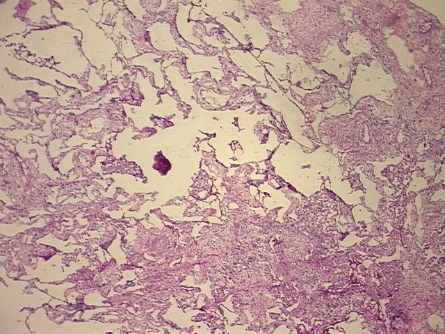 Frozen Tissue Sections, Lung: right upper lobe | OriGene Technologies Inc.